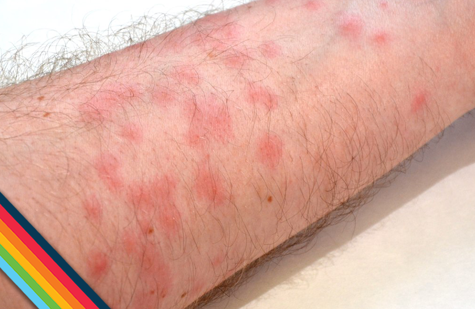 First Case of Rare, Sexually Transmitted Form of Ringworm Reported in ...